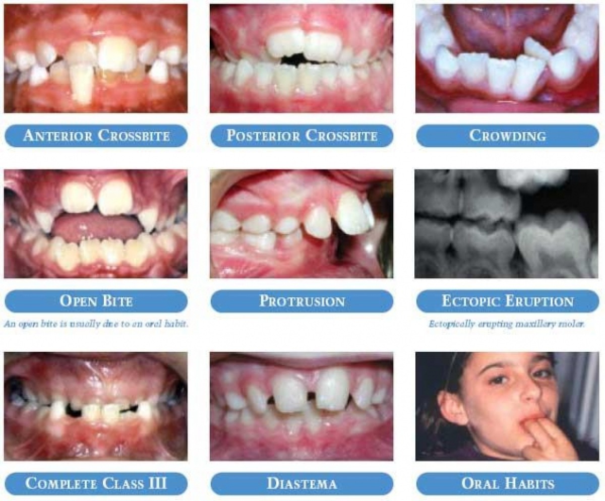 Dental Occlusion Classification Canine