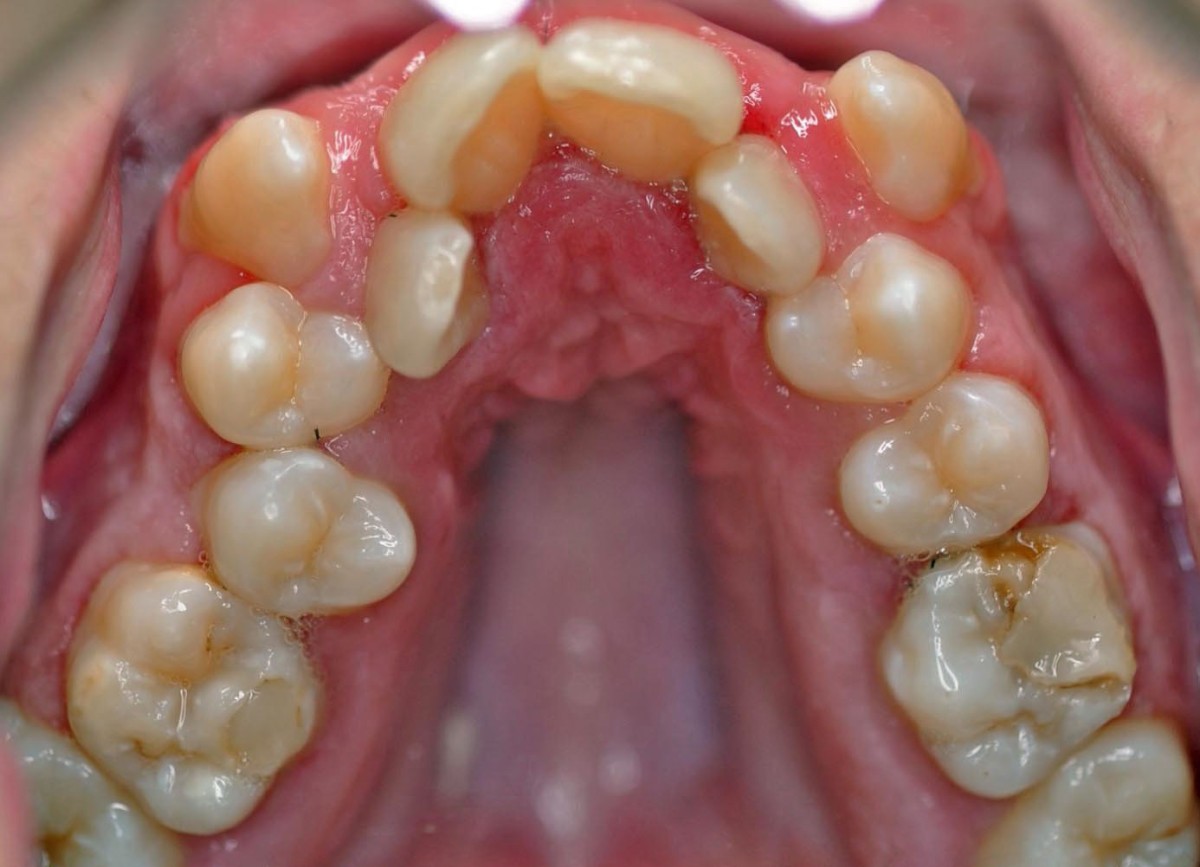 Tongue Tie Watkins Dental