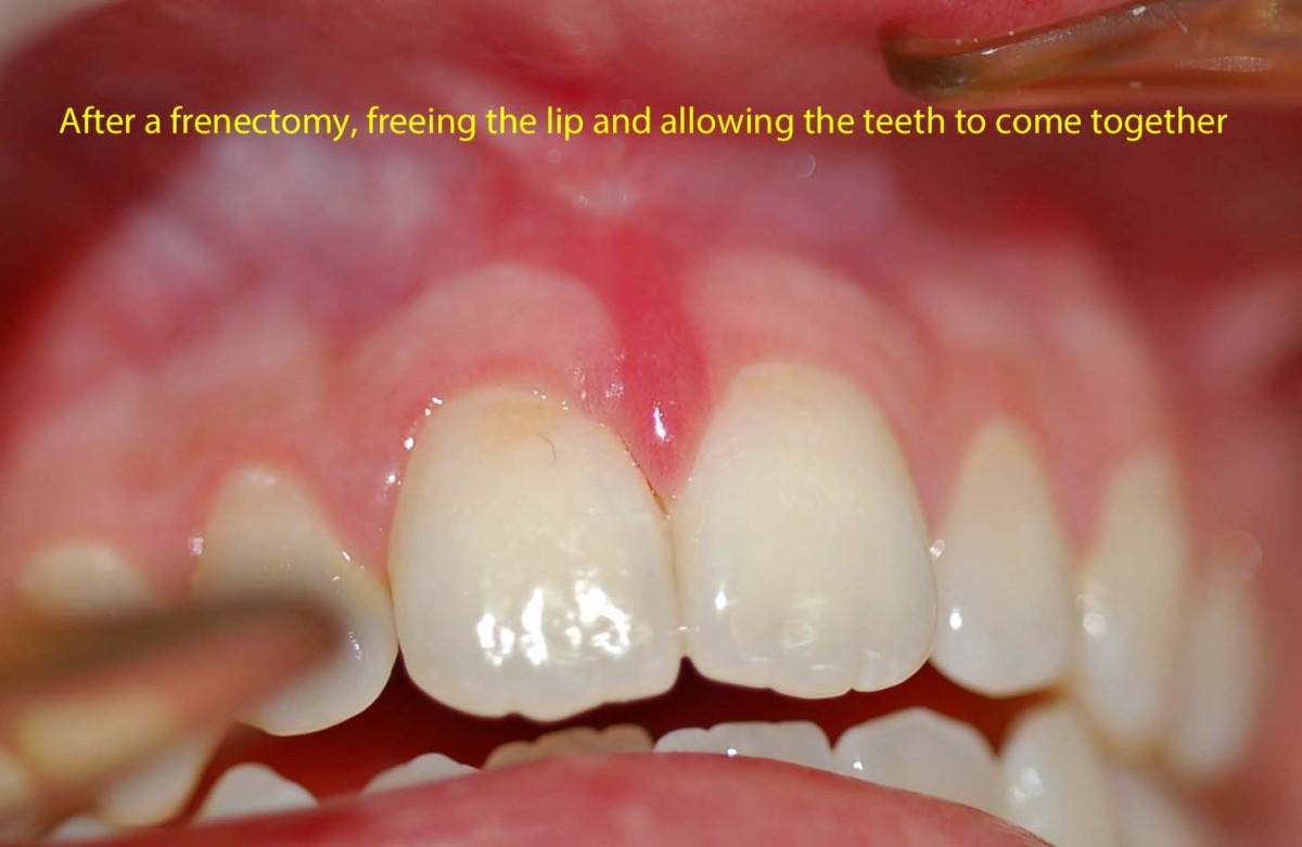 Tongue Tie Watkins Dental